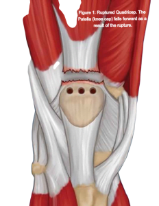 Repairing a Chronic Quadricep Rupture and Knee Replacement - Dr Robert ...